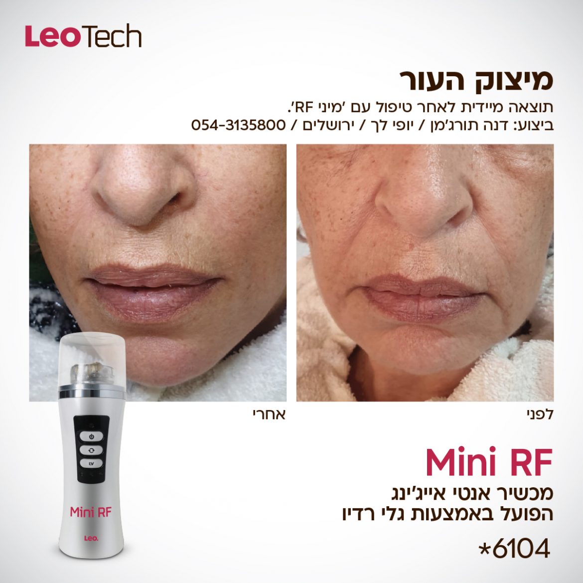 מכשיר למיצוק העור בגלי רדיו: MINI RF מכשיר למתיחת העור שעובד | לאונרדו